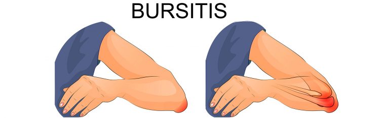 Bursitis - Causes, Symptoms, and Treatments